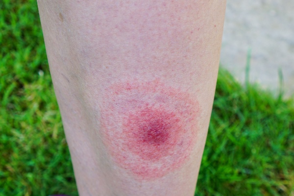 Tick Identification: What Does a Tick Look Like?