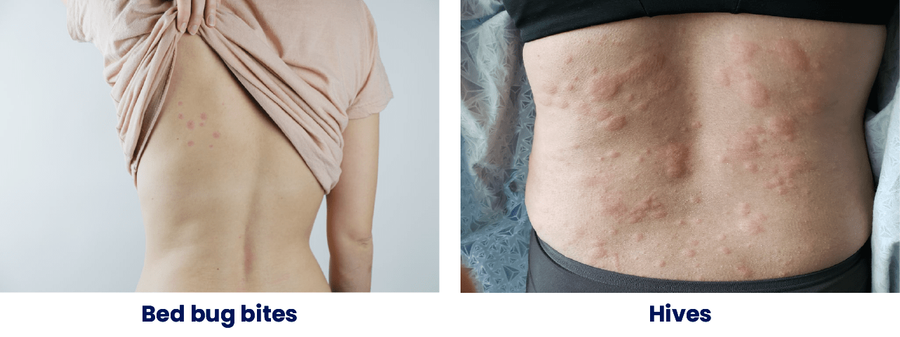 Identifying Bed Bugs Bites: Signs, Symptoms, and Prevention